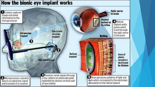 Artificial retina | PPT