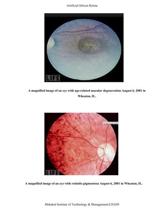 Artificial silicon retina main | DOC | Eye and Vision Conditions ...