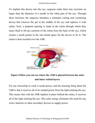 Artificial silicon retina main | DOC