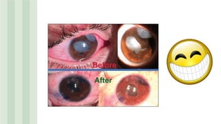Art of iris repair ppt | PDF
