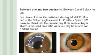 Art of iris repair ppt | PDF