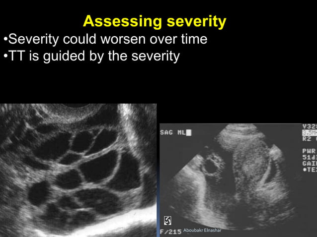 Treatment of OHSS | PPTX