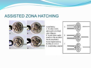 ASSISTED REPRODUCTIVE TECHNIQUES | PPTX