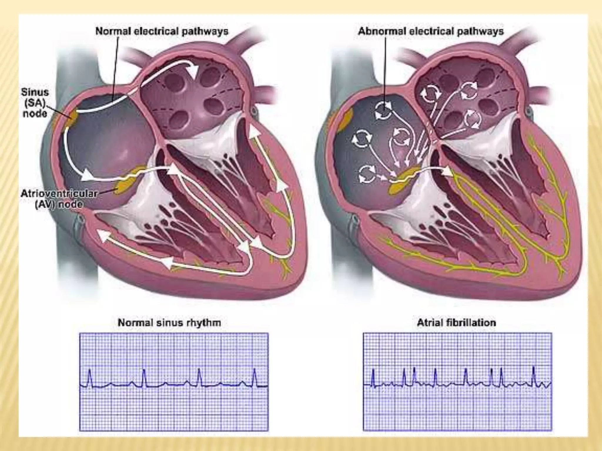 Artrial fibrillation classification & management guideline | PPTX
