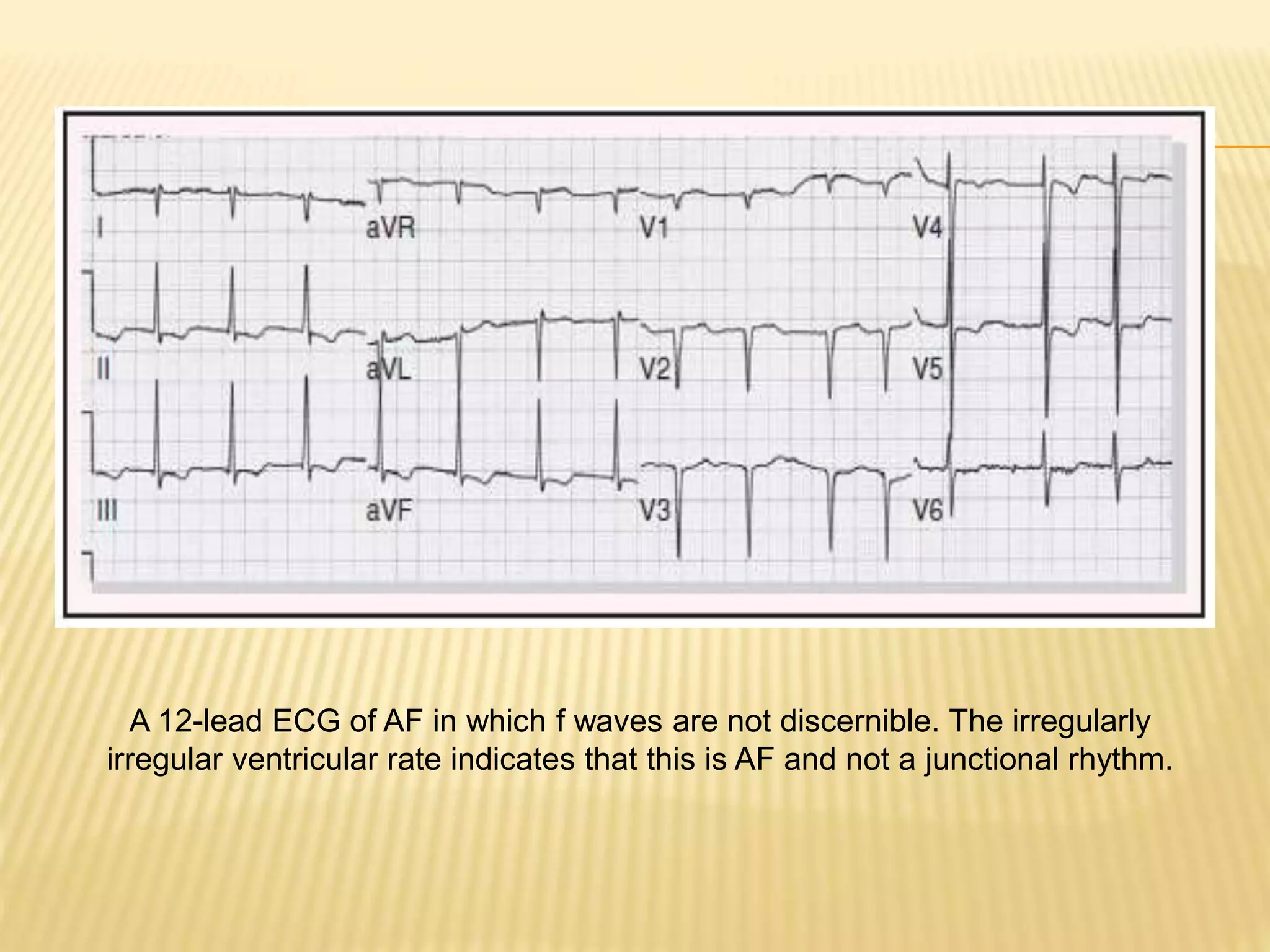 Artrial fibrillation classification & management guideline | PPTX