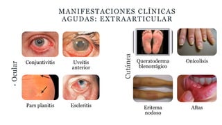 Artritis reactiva en pediatría revición .pptx