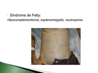 Artritis reumatoide (AR) | PPT