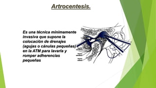 Artrocentesis.pptx