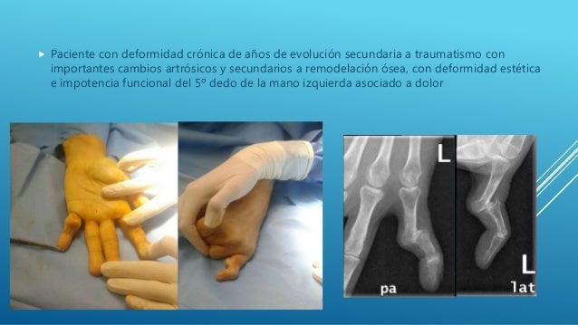 Artrodesis interfalangica proximal 5 º dedo mano