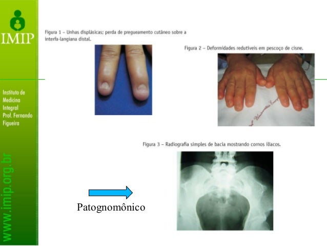 Artrogripose - André Cipriano