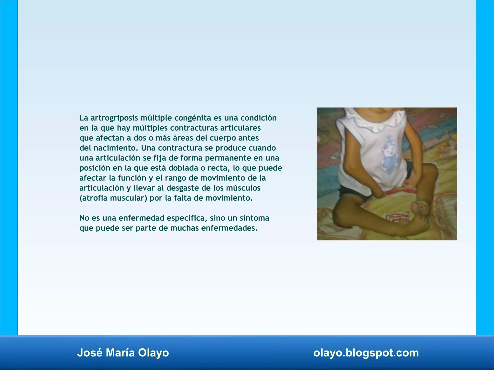 Artrogriposis múltiple congénita. | PDF | Bone and Joint Conditions ...
