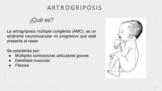 Artrogriposis y osteogenesis imperfecta.pptx