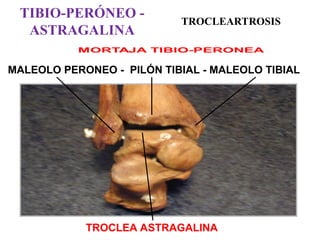 Artrologia-Miembros-Inferiores-cuerpohumano.ppt