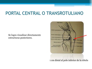 Artroscopia De Rodilla Dra Eglee Alvarez | PPTX