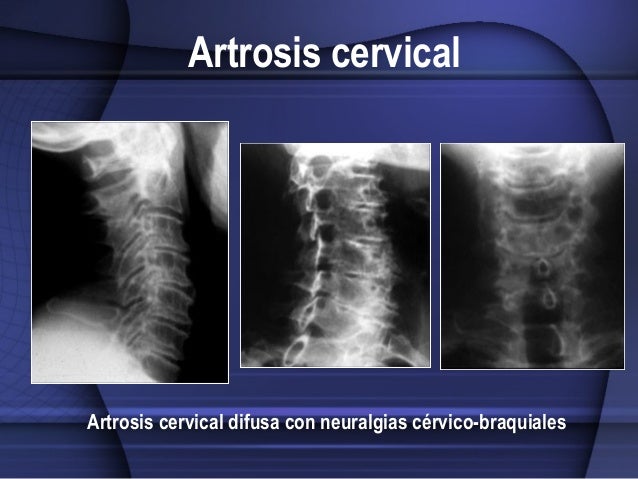 Artrosis cervical dr. sandy cadena