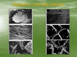 Artrosis de cadera | PPTX