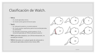 Artrosis de hombro su estudio para manejo quirurgico | PPTX