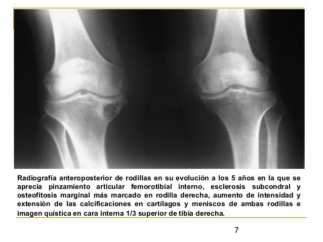 Artrosis de rodilla dr. sandy cadena