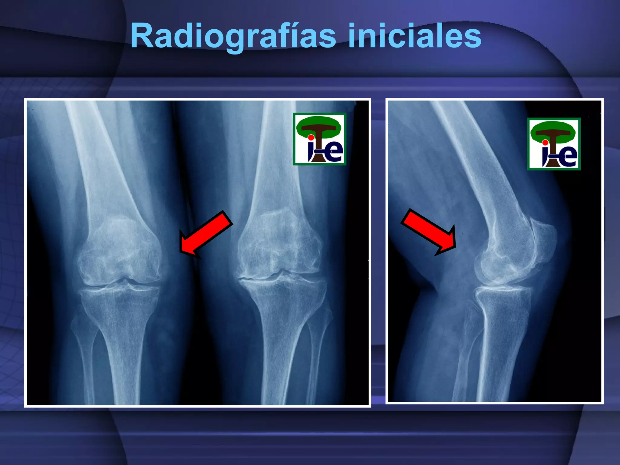 Artrosis de rodilla por genu valgo | PPT