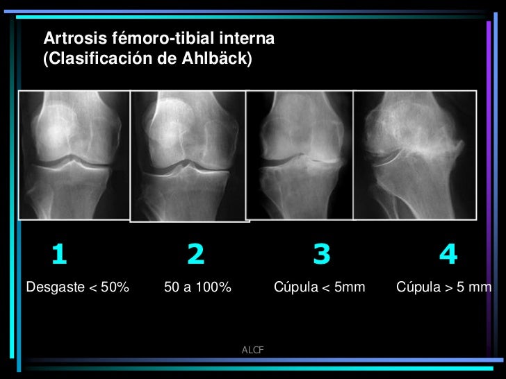 Artrosis femorotibial