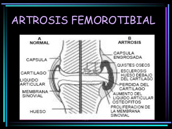 Artrosis femorotibial