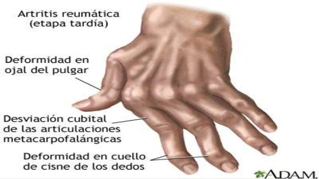 Artrtitis Reumatoide y sus deformidades en mano y muñeca