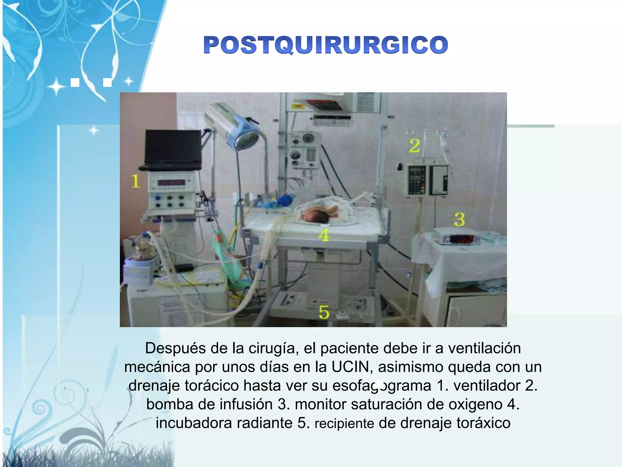 Atresia esofágica y fistula traqueo esofagica | PPTX