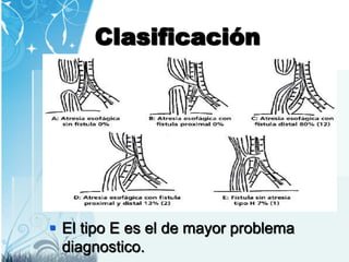 Atresia esofágica y fistula traqueo esofagica | PPTX