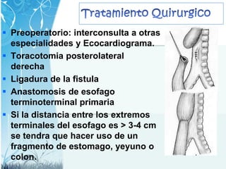 Atresia esofágica y fistula traqueo esofagica | PPTX