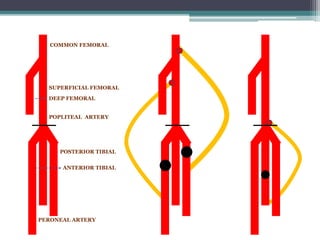 INFRAGENICULAR-BYPASS-REVASCULARISATION.pptx