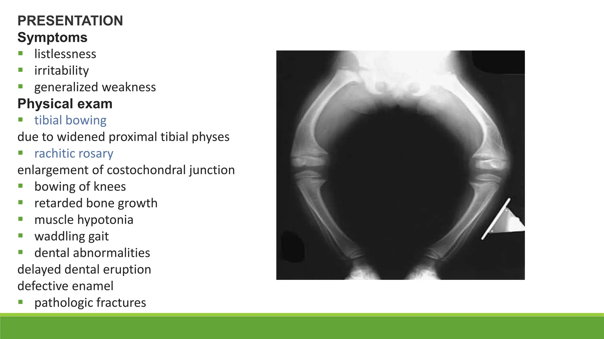METABOLIC BONE DISEASES - Rickets, Scurvy, Osteomalacia. | PPTX