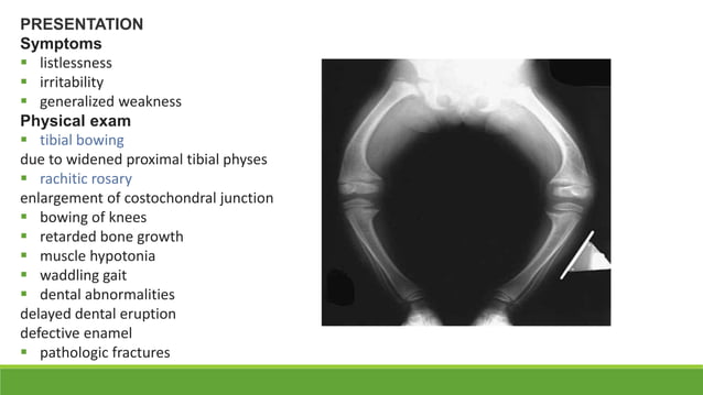 METABOLIC BONE DISEASES - Rickets, Scurvy, Osteomalacia. | PPTX | Bone ...