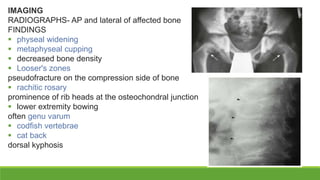 METABOLIC BONE DISEASES - Rickets, Scurvy, Osteomalacia. | PPTX