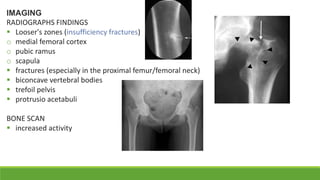 METABOLIC BONE DISEASES - Rickets, Scurvy, Osteomalacia. | PPTX