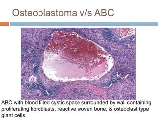 osteogenic bone tumors & fibrous dysplasia | PPTX