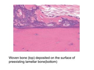 osteogenic bone tumors & fibrous dysplasia | PPTX