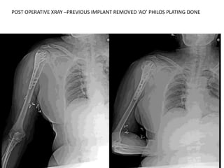 Aruna proximal humerus | PPTX