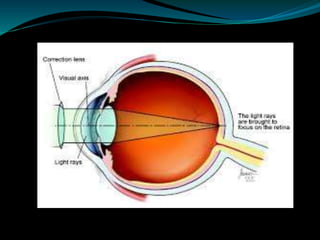 spectacle refraction versus ocular refraction | PPTX