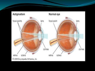 spectacle refraction versus ocular refraction | PPTX