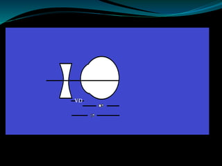 spectacle refraction versus ocular refraction | PPTX