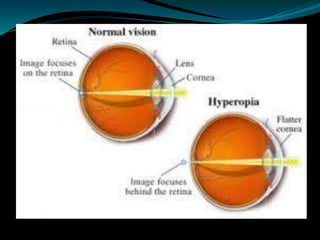 spectacle refraction versus ocular refraction | PPTX