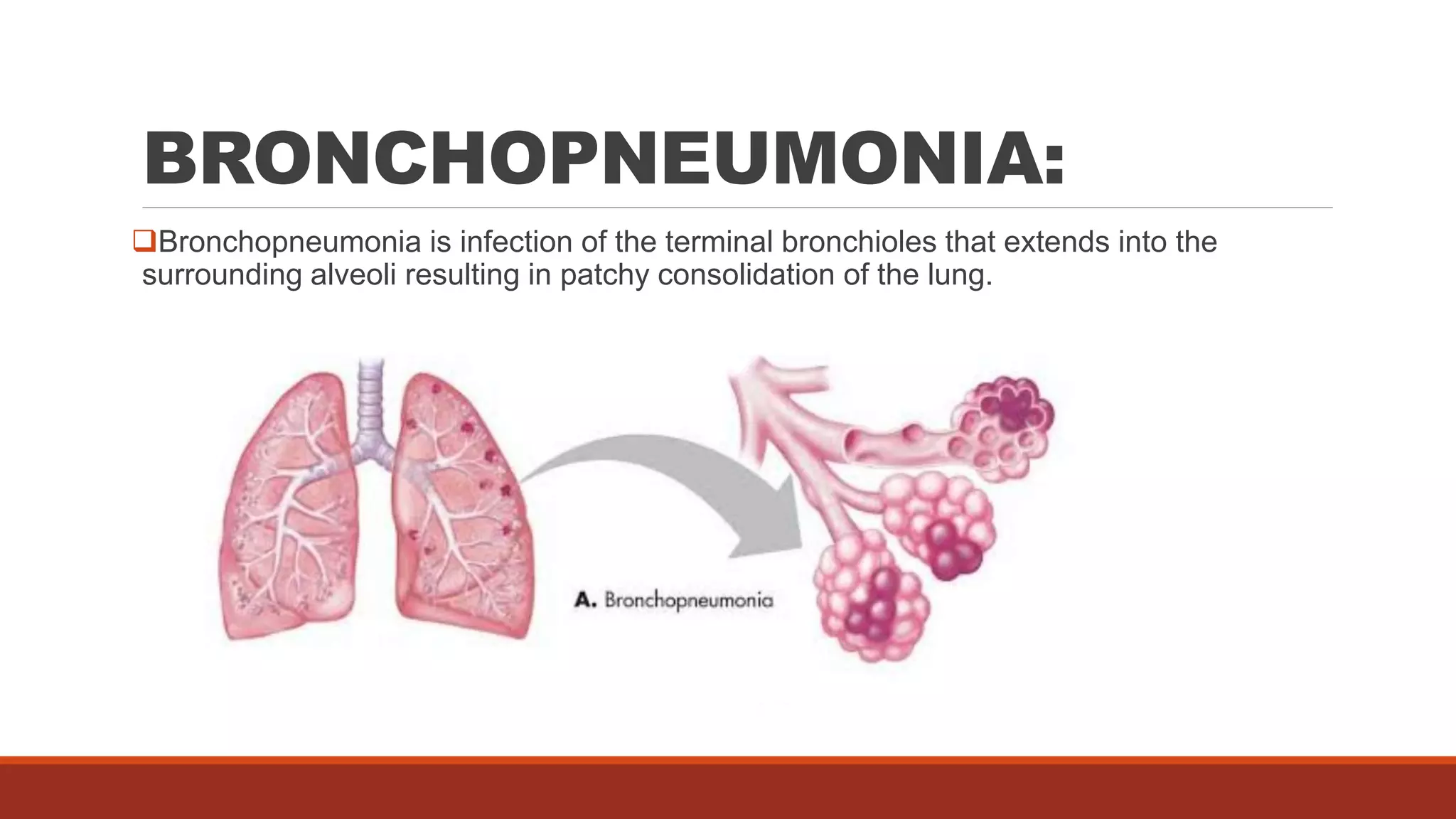 PNEUMONIA PATHOPHYSIOLOGY.pptx