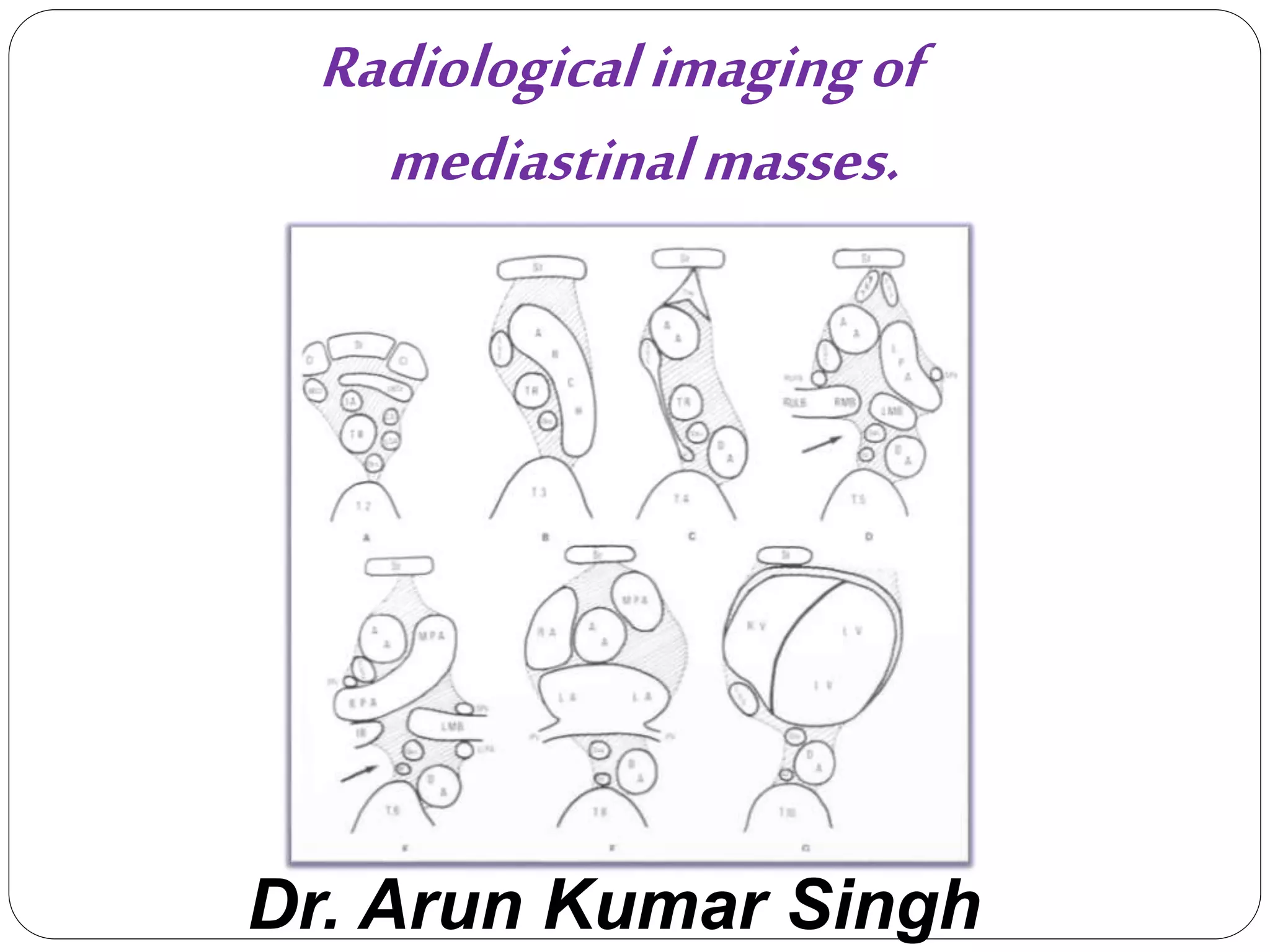 Mediastinal Imaging And Masses Ppt