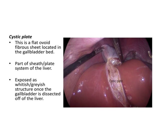 ARUNSAFE CHOLECYSTECTOMY.pptx