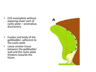 ARUNSAFE CHOLECYSTECTOMY.pptx