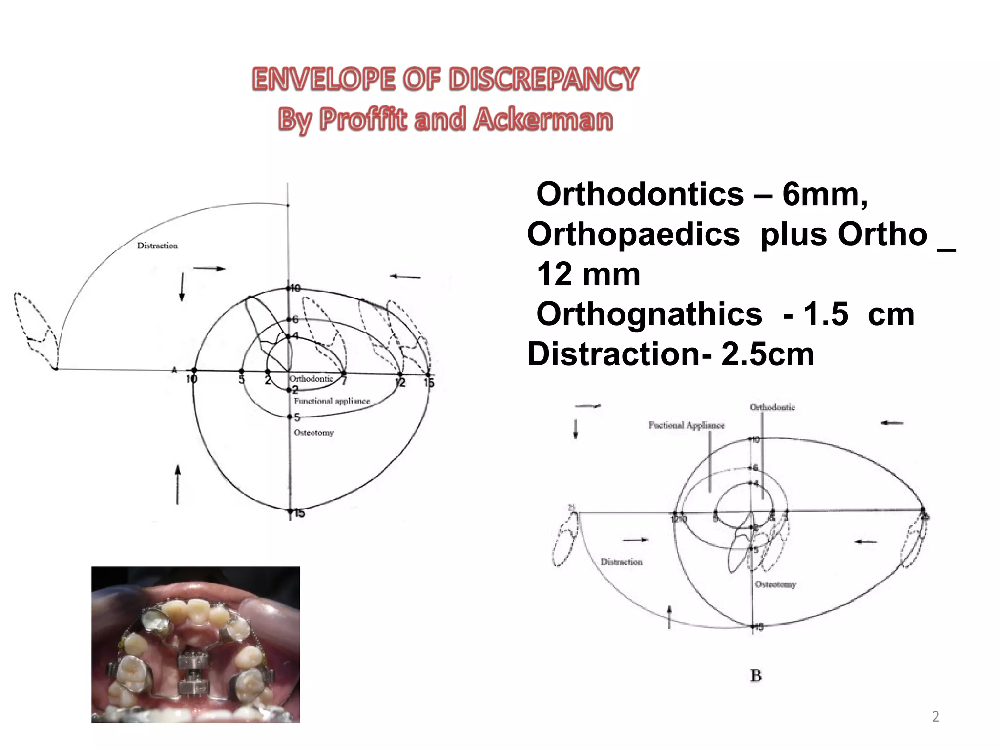 Lip repositioning surgery for Gummy Smile Correction | PPT