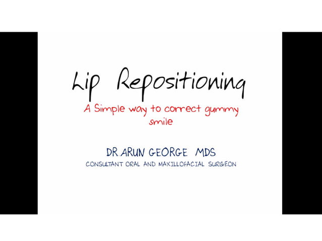 Lip repositioning surgery for Gummy Smile Correction | PPT | Dental ...