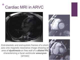 arrhythmogenic right ventricular dysplasia/Cardiomyopathy | PPTX