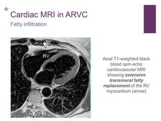 arrhythmogenic right ventricular dysplasia/Cardiomyopathy | PPTX