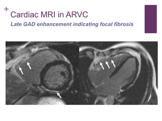 arrhythmogenic right ventricular dysplasia/Cardiomyopathy | PPTX